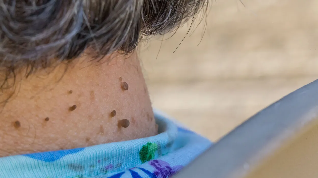 Durillons aux mains et/ou aux pieds : comment les soigner ? - RTBF Actus