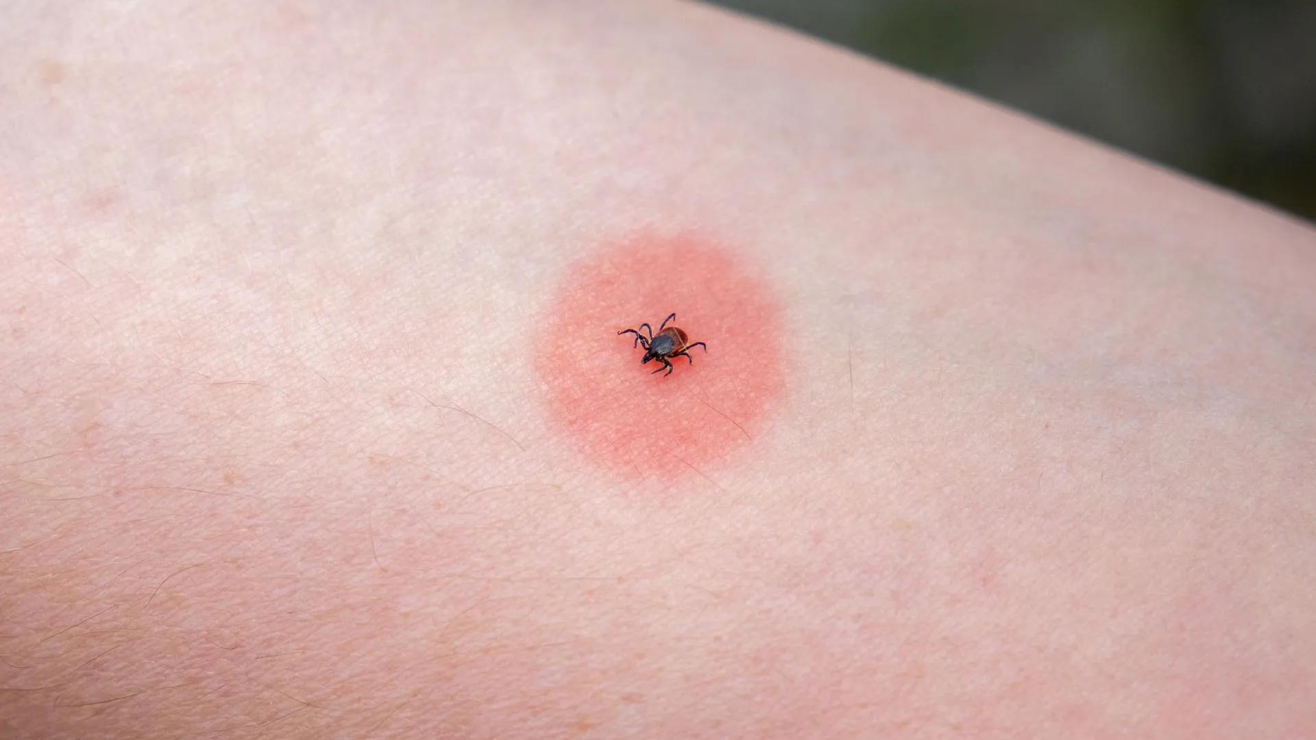 Maladie de Lyme : comment la bactérie Borrelia burgdorferi nous infecte ...