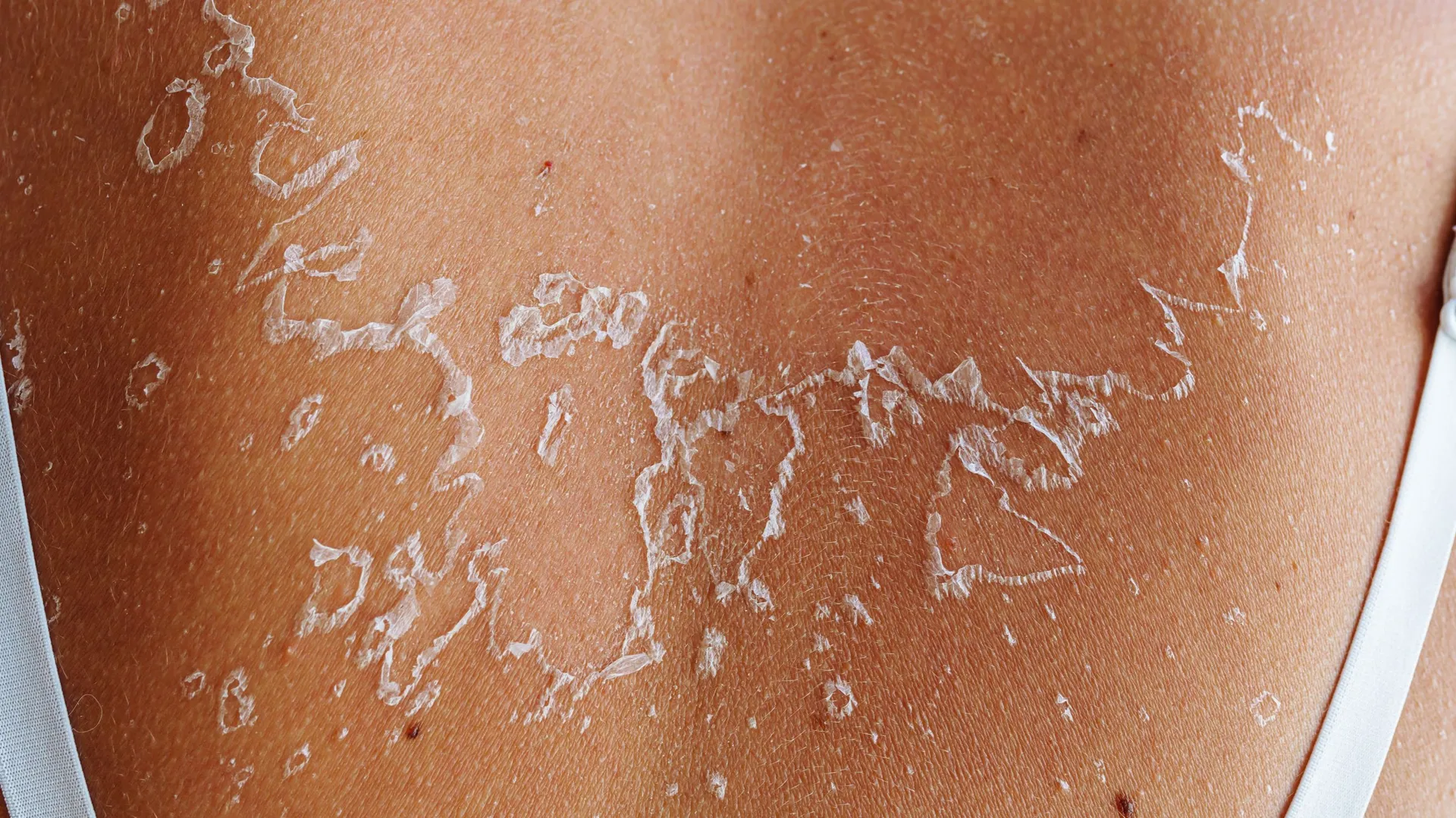 Comment différencier les brûlures du 1er, 2e ou 3e degré et les soigner ...