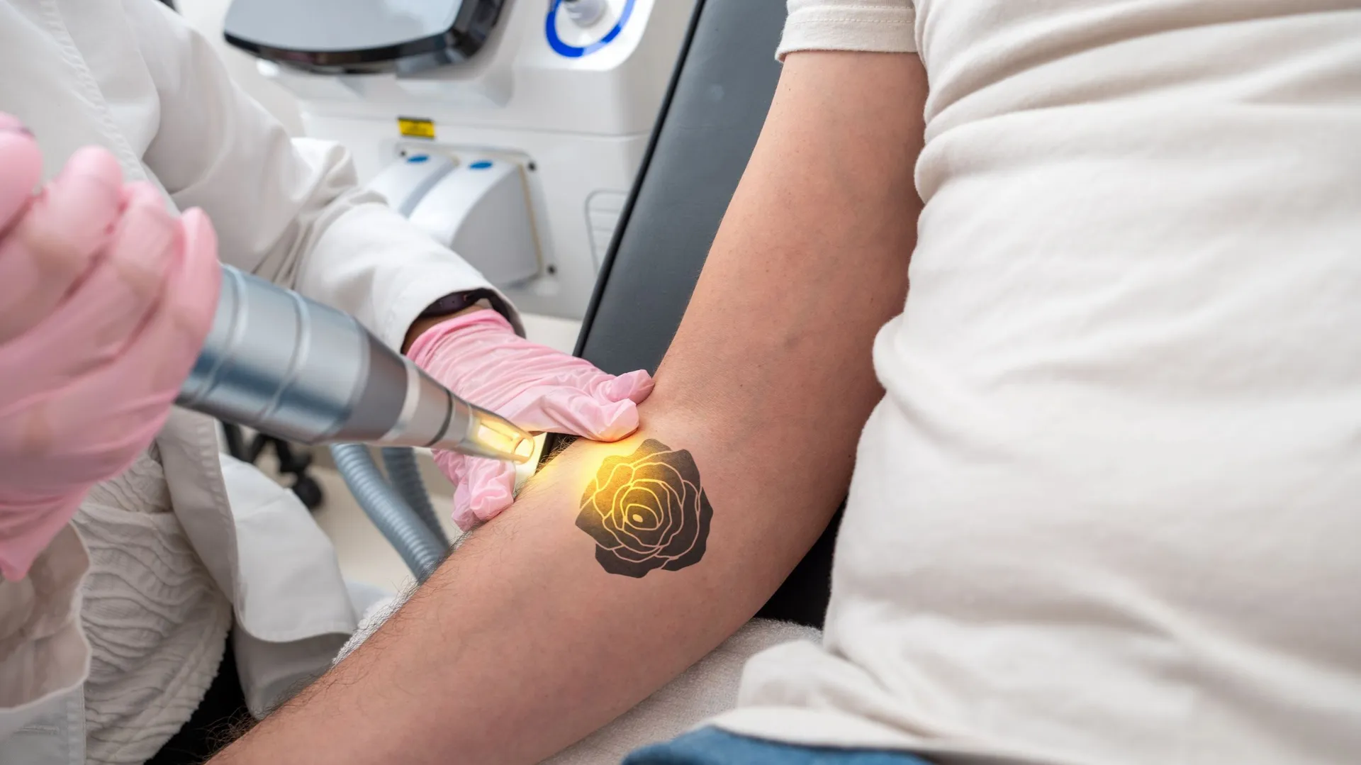 Le détatouage au laser : quels sont les risques ? - RTBF Actus