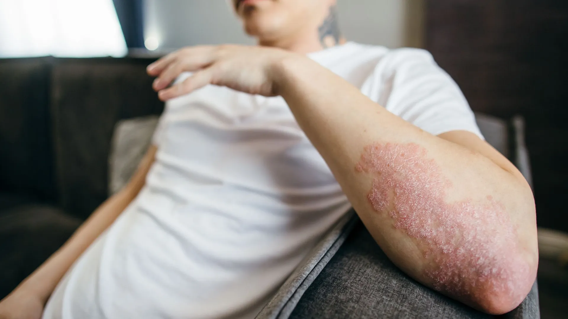 Le psoriasis : cette maladie de la peau qui affecte des millions de ...