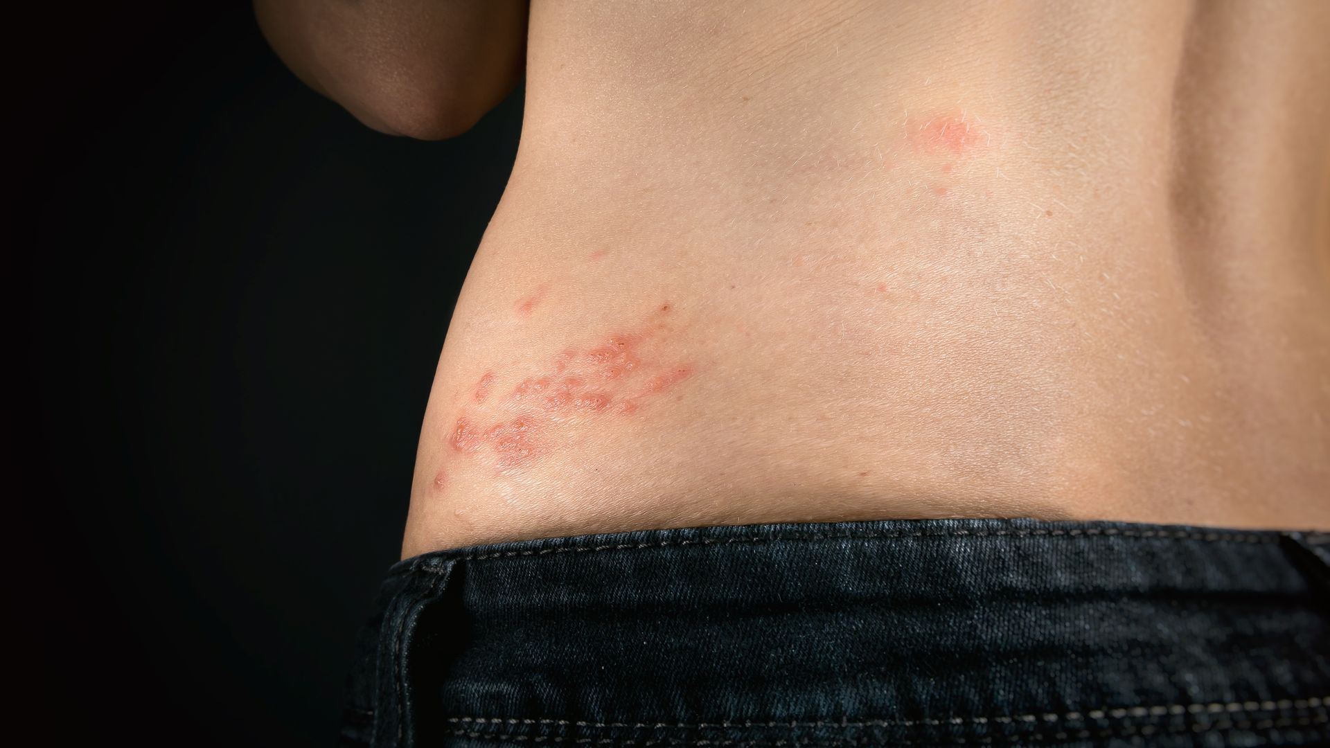 Le zona : une maladie virale douloureuse et méconnue qui touche des ...